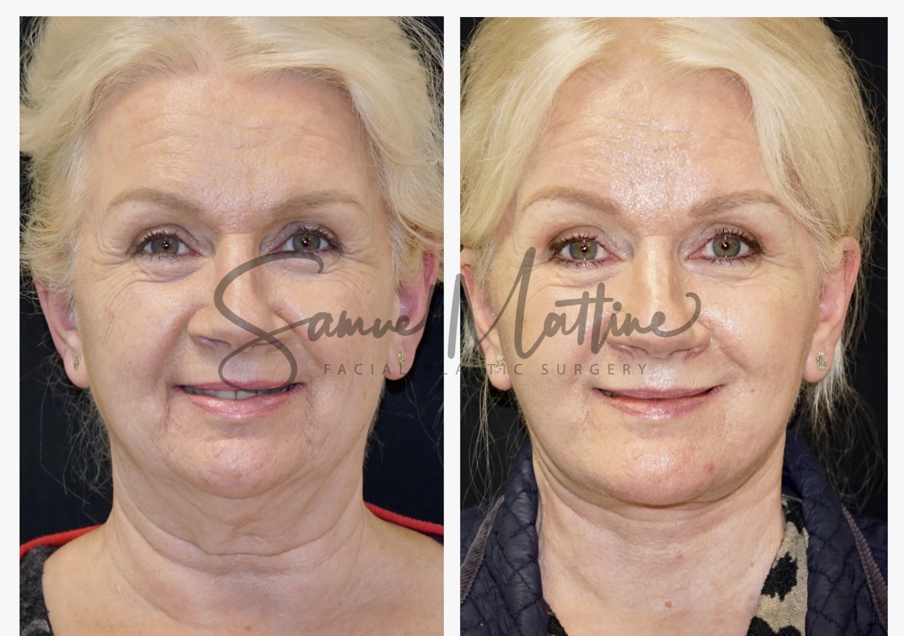 CHIN IMPLANT AND NECK TREATMENT