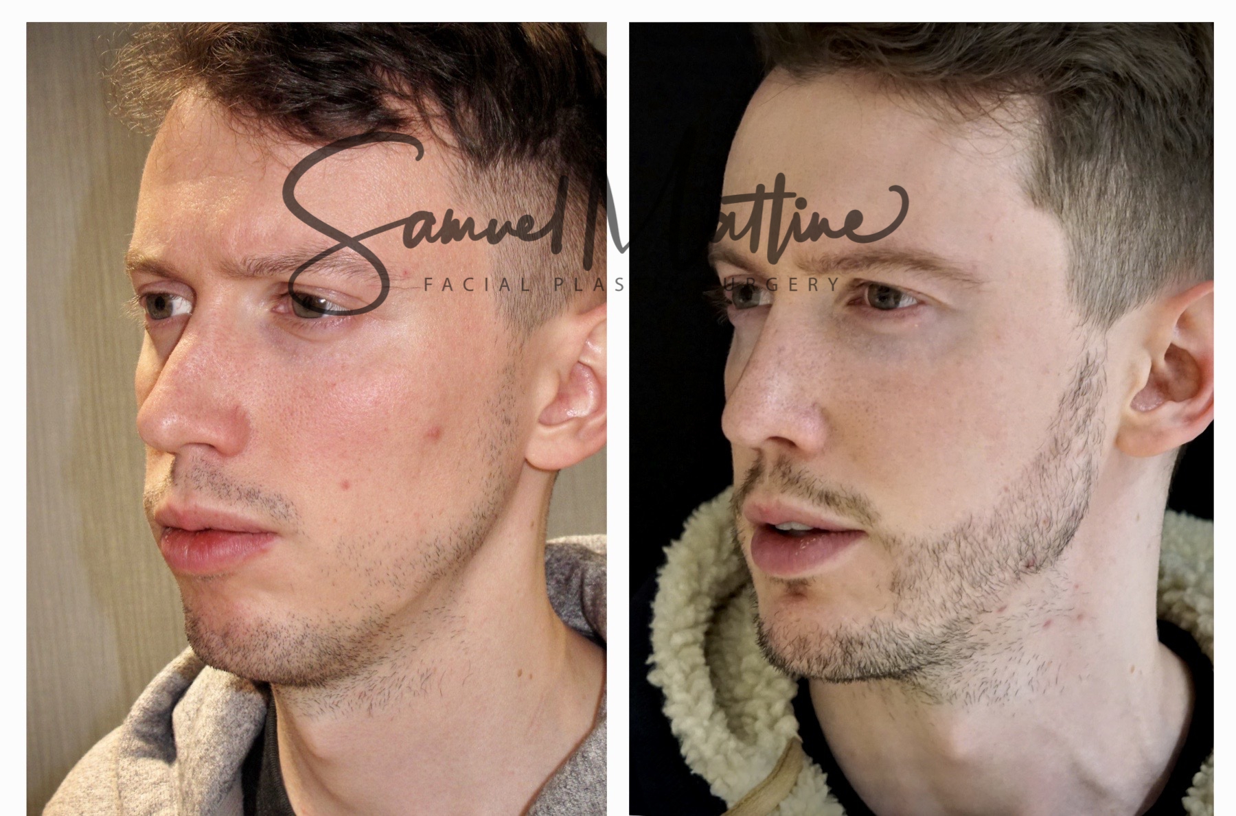 CHIN IMPLANT